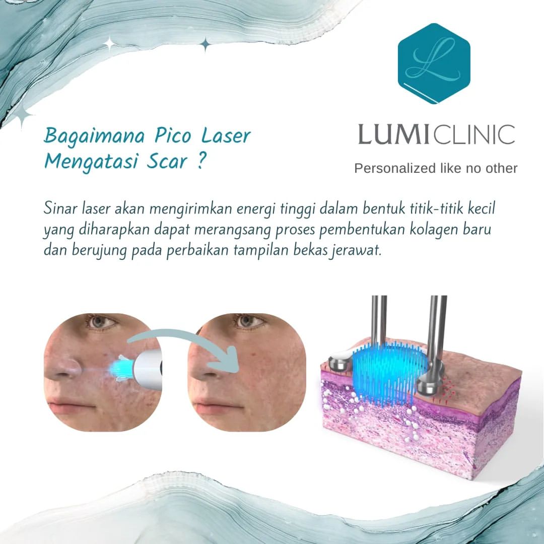 Treatment Pico Plasma Laser – Lumi Clinic