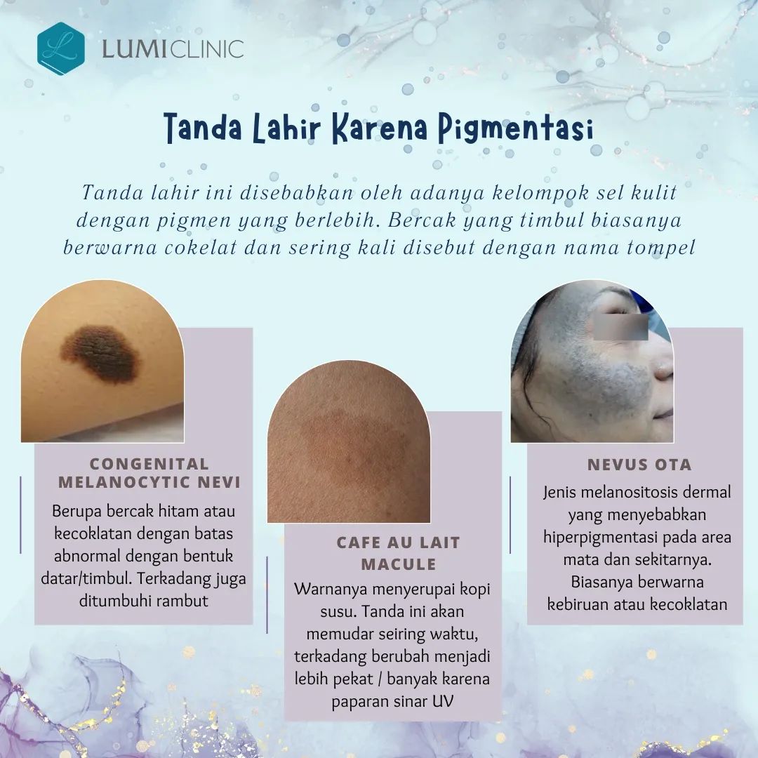 Tanda Lahir – Lumi Clinic